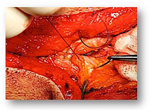open midline laparotomy