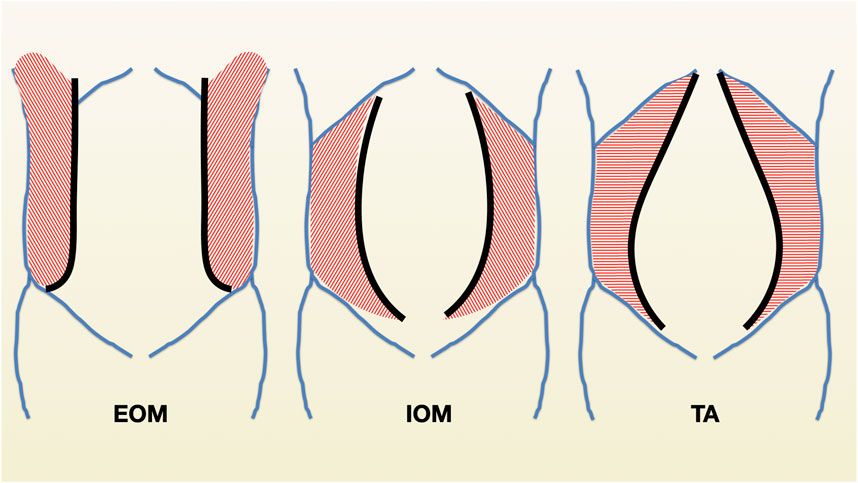 laparotomy incision types