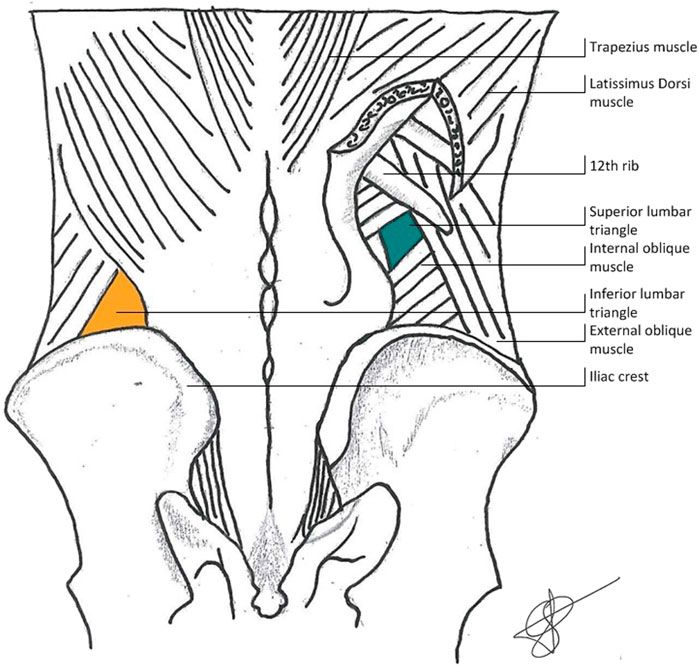 lumbar hernia types