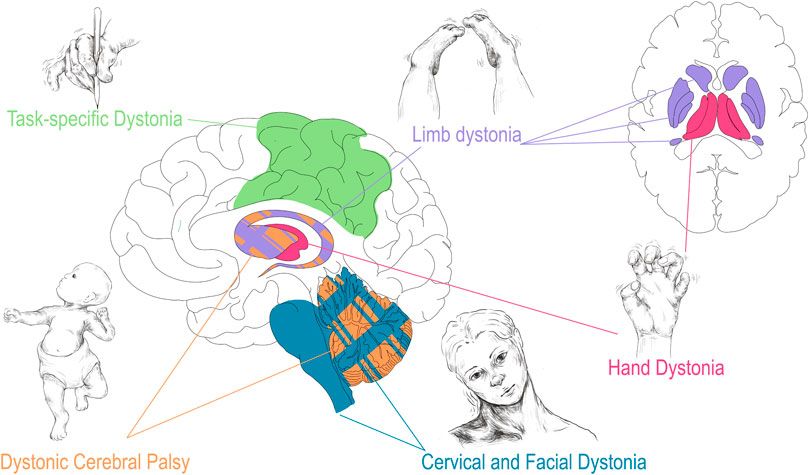 opisthotonic posturing causes