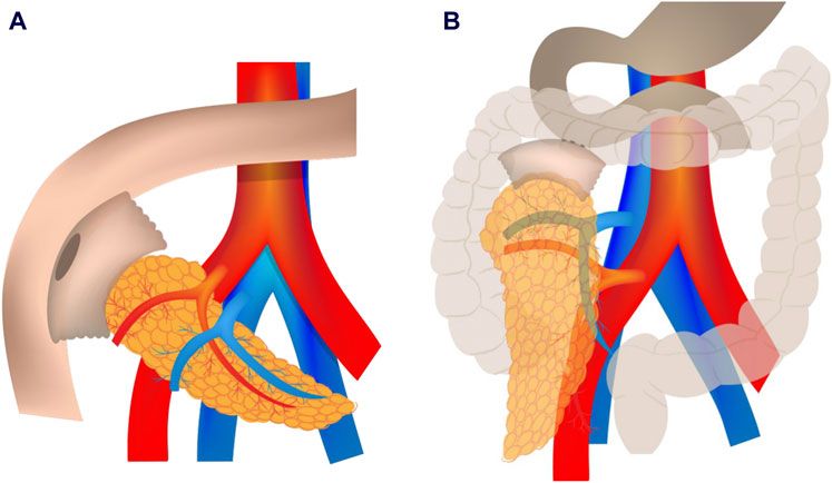 duodenojejunostomy steps