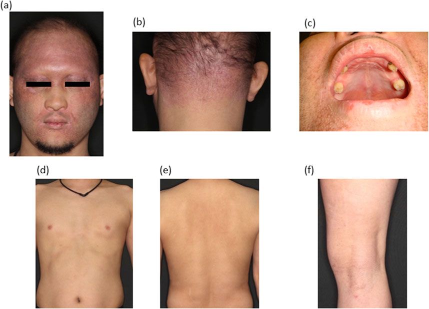 ectodermal dysplasia types
