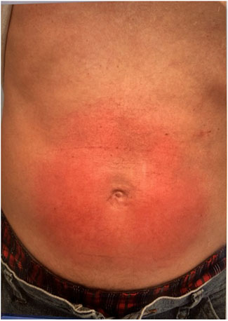 Frontiers Publishing Partnerships | Patients With Systemic Reaction to ...