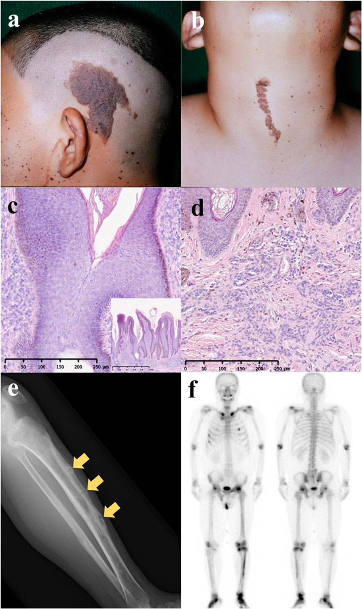 Frontiers Publishing Partnerships | Adult epidermal nevus syndrome with hypophosphatemic ...
