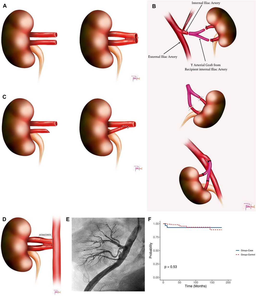 Frontiers Publishing Partnerships | Vascular Reconstruction of Multiple Renal Arteries—A Risk ...