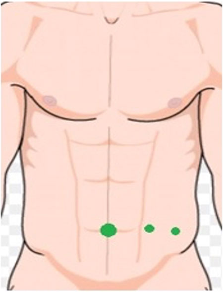 Frontiers Publishing Partnerships | Complicated Inguinocrural Hernias ...